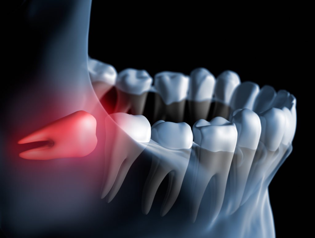 Infected Wisdom Teeth: All You Need to Know, According to Dr. Thomas ...